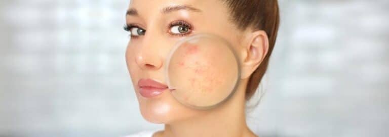 PRP for Acne Scars | Beverly Hills & Los Angeles PRP Clinic