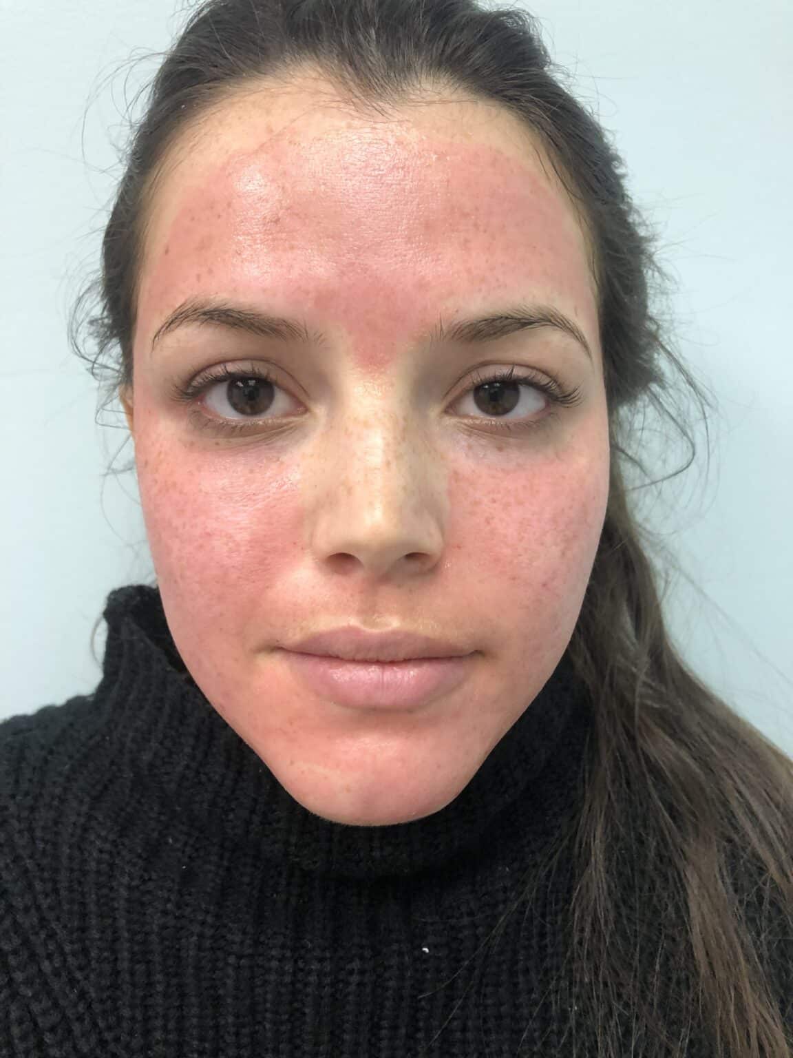 PRF Hair Restoration - PRF Undereyes Beverly Hills, Los Angeles