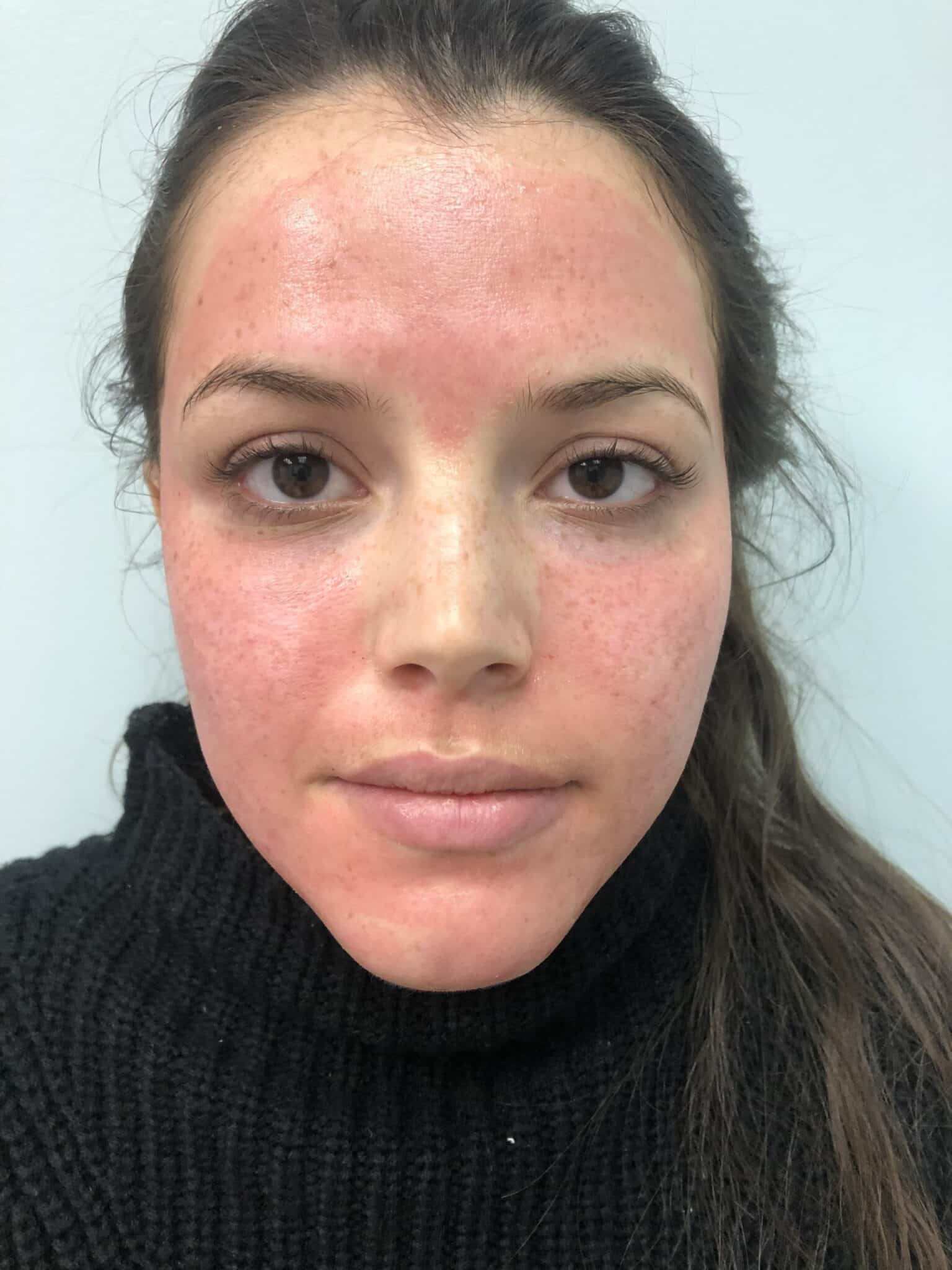 PRF Hair Restoration - PRF Undereyes Beverly Hills, Los Angeles