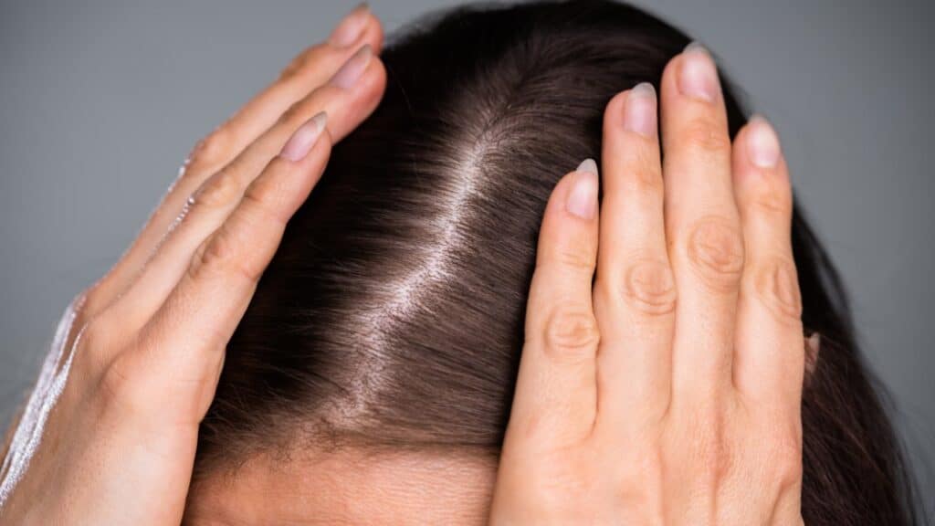 Androgenetic Alopecia in Women | PRP Treatment